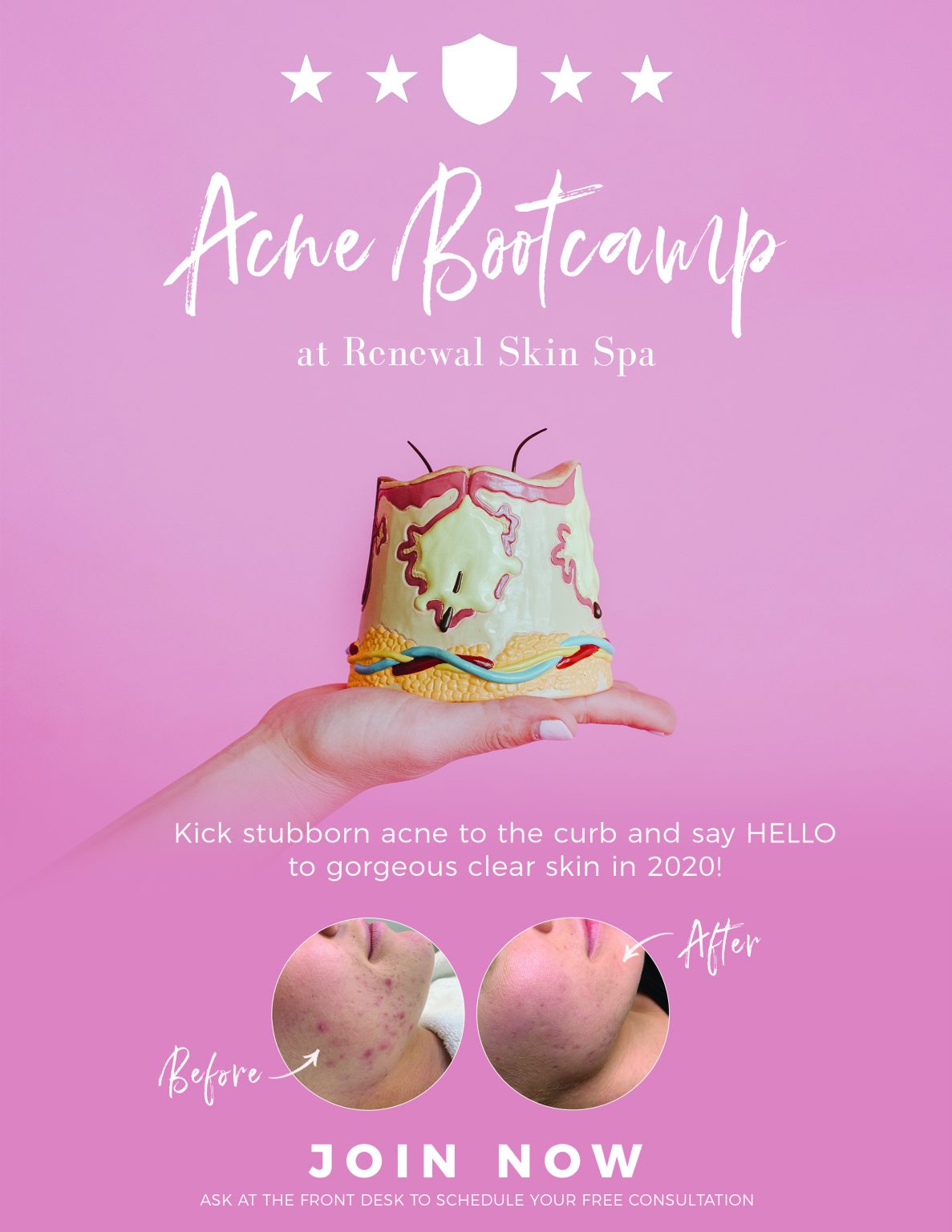 Acne Treatments – Renewal Skin Spa