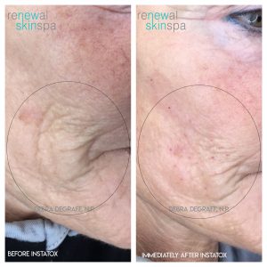 Botox for Neck Band | Wrinkles | Chin Dimple Area | | Renewal Skin Spa