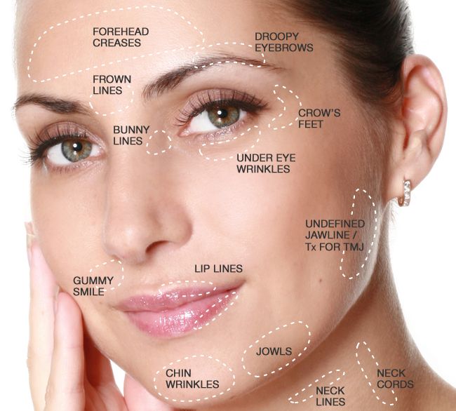 Dysport-Botox-treatment-areas – Renewal Skin Spa