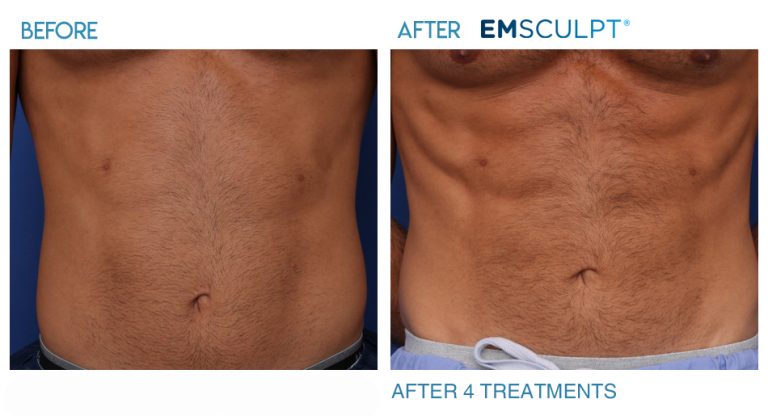 Emsculpt-abs-before-and-after – Renewal Skin Spa