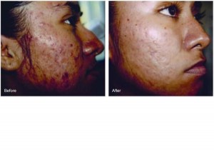 chemical_peels_acne_scars – Renewal Skin Spa